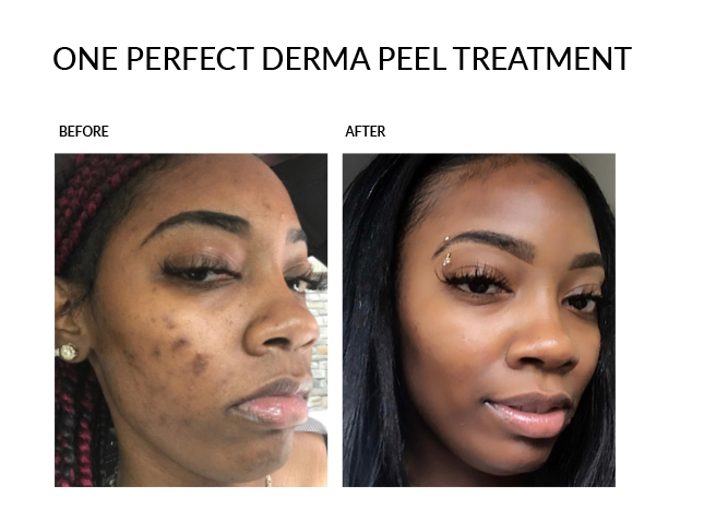 Best Perfect Derma Peel In Arlington VA | MalakSkinCare