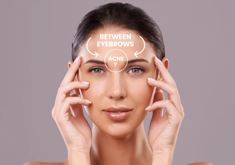 Clearing The Way: Home Remedies To Banish Acne Between Eyebrows | Malak ...