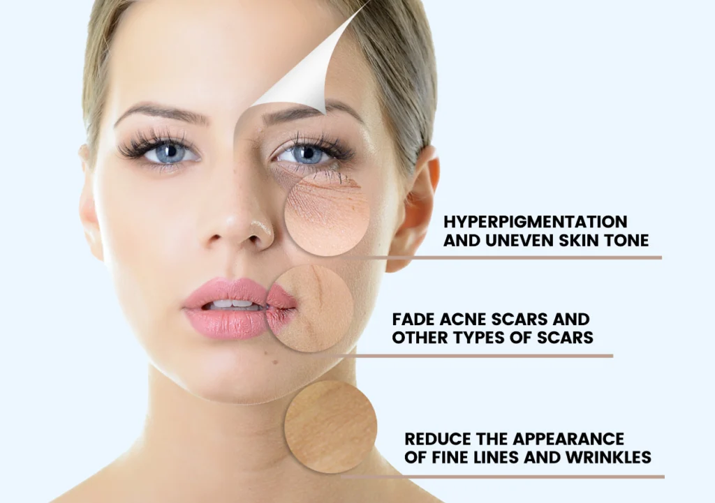 What Is Microneedling: All You Need To Know | Malak Skincare