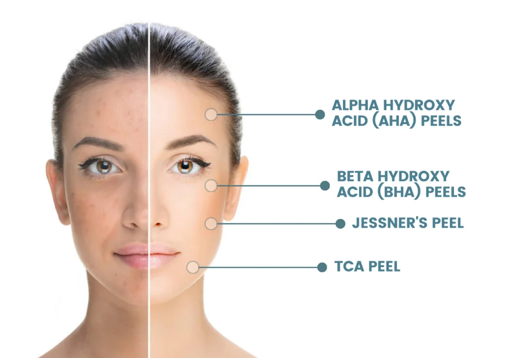 How To Use Face Peels For Scar Treatment | Malak Skincare