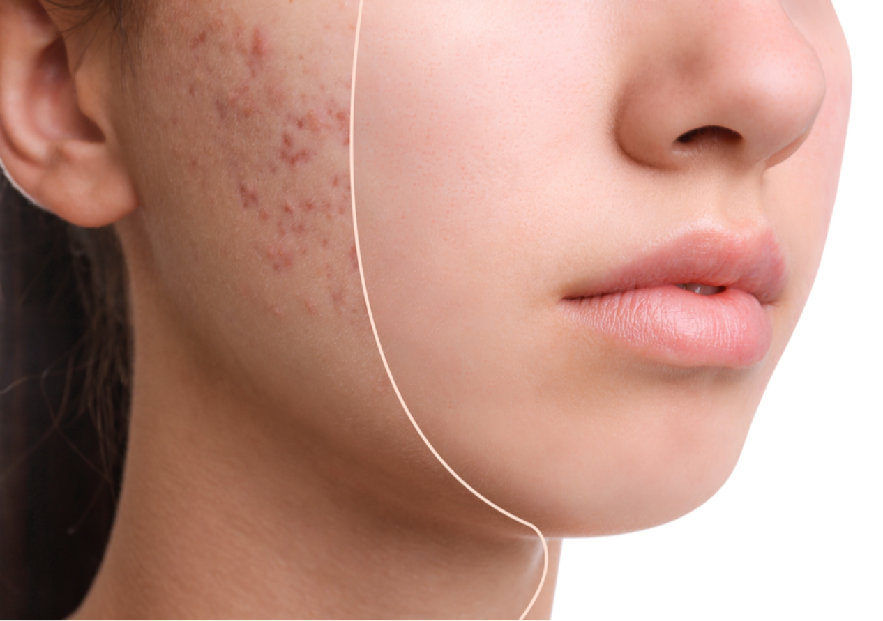 How To Use Face Peels For Scar Treatment | Malak Skincare